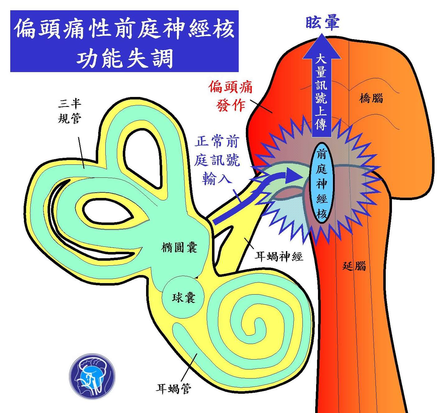 偏頭痛又眩暈？又痛又暈！認識偏頭痛性眩暈症，留意眩暈方向 今健康